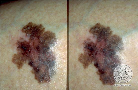 A quoi ressemble un mélanome ? Photos.